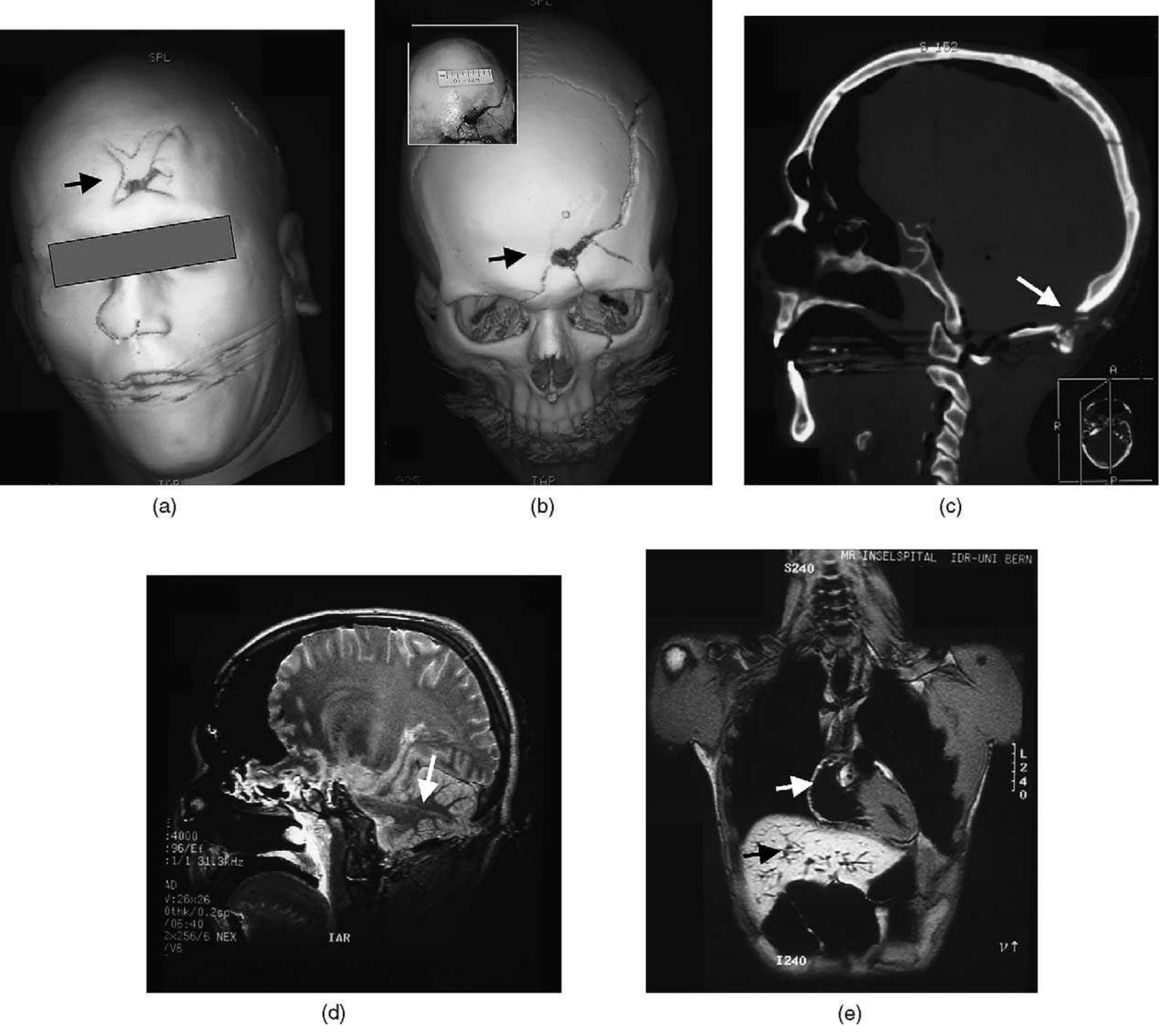 Ct and mri of case 6. (a) 3d ct surface reconstruction of