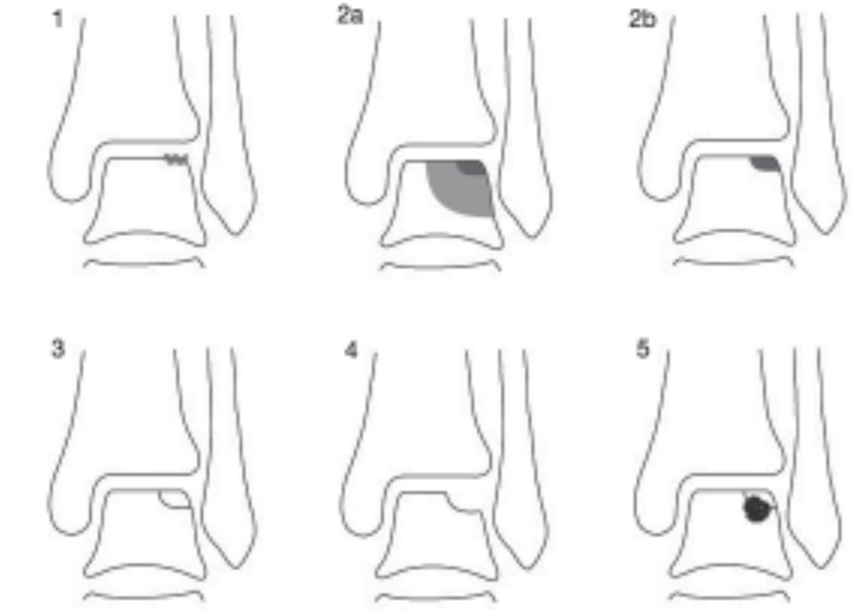 Classification of osteochondral lesions of the talus using