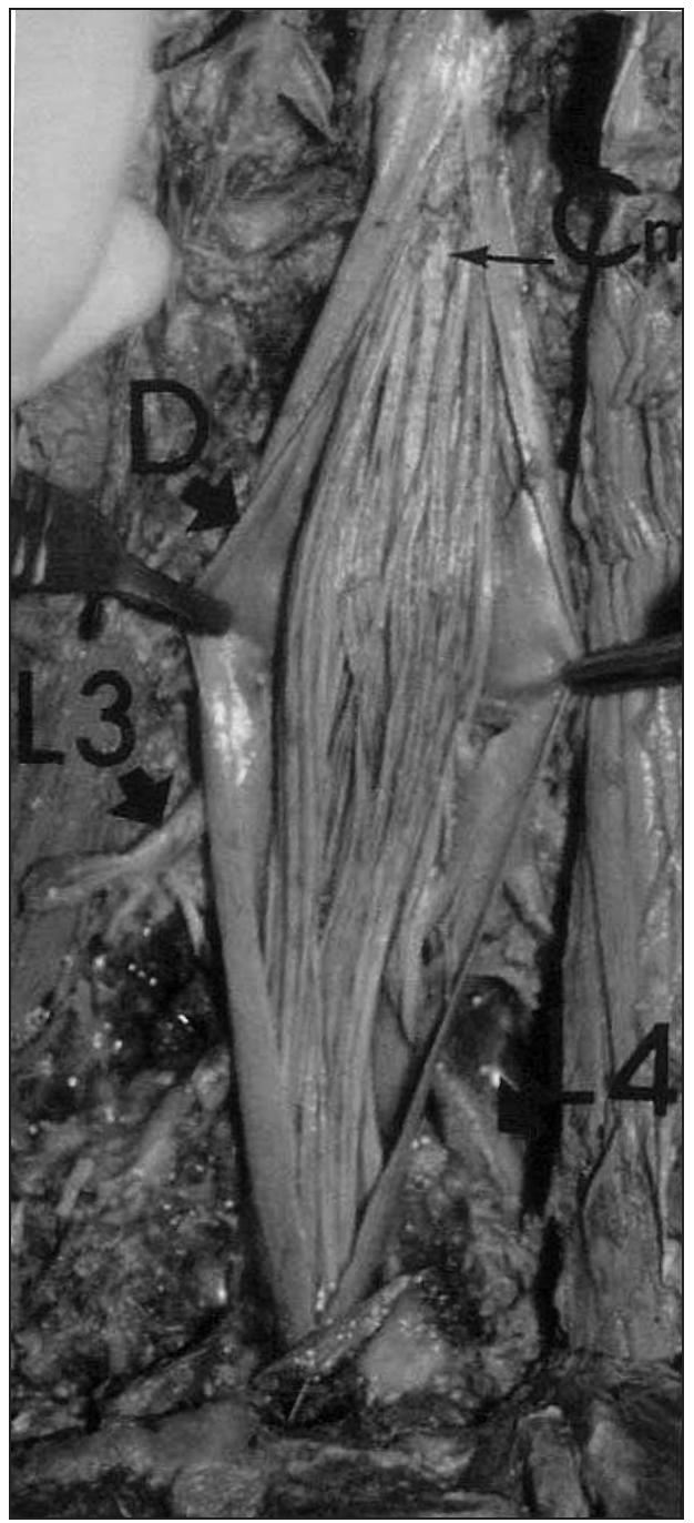 The exposure of cauda equina and conus medullaris after