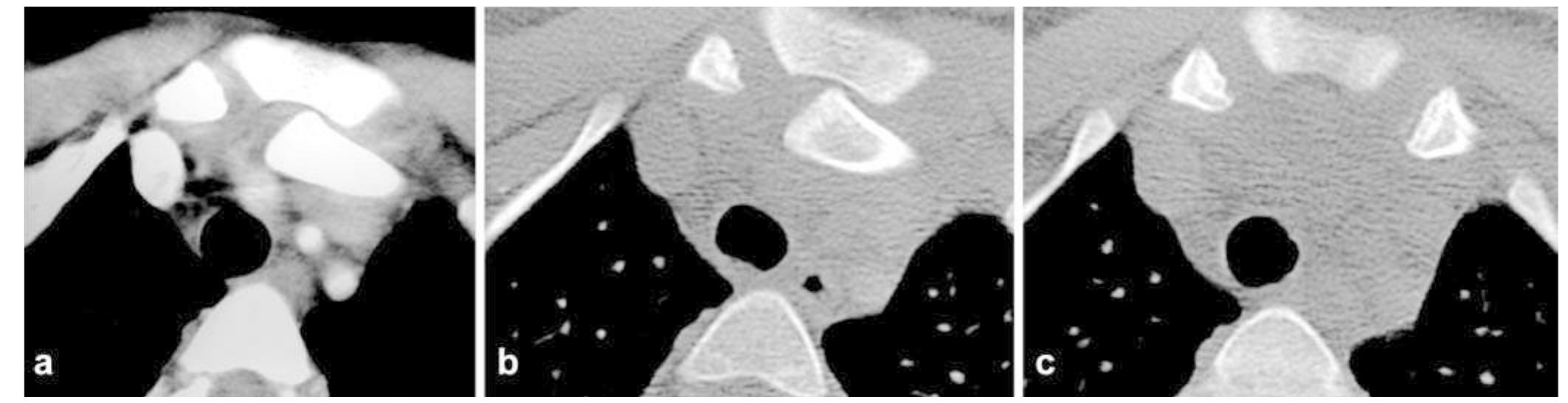 A—c left posterior sternoclavicular dislocation. axial con-