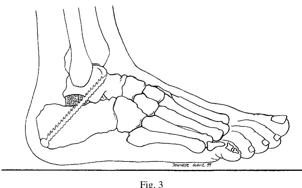 Diagram showing a bone block placed in the subtalar joint