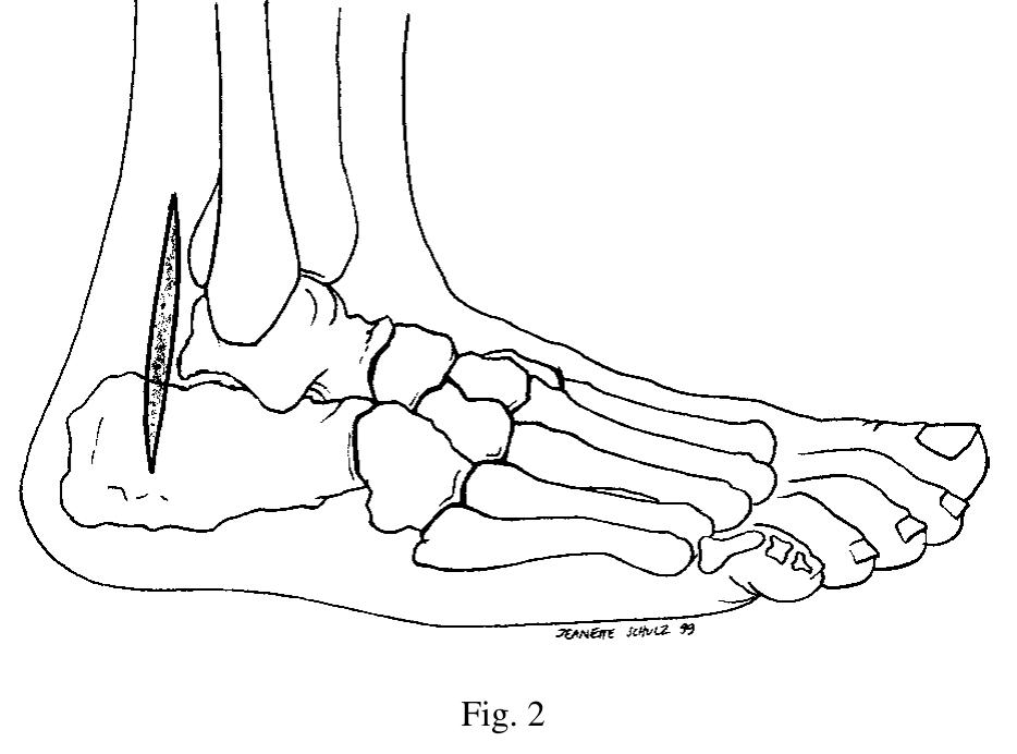 Diagram showing vertical incision which allows closure