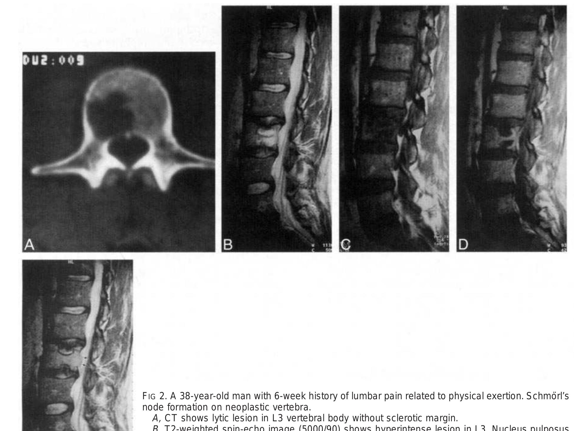 Herniated fragment of the nucleous pulposus inside the