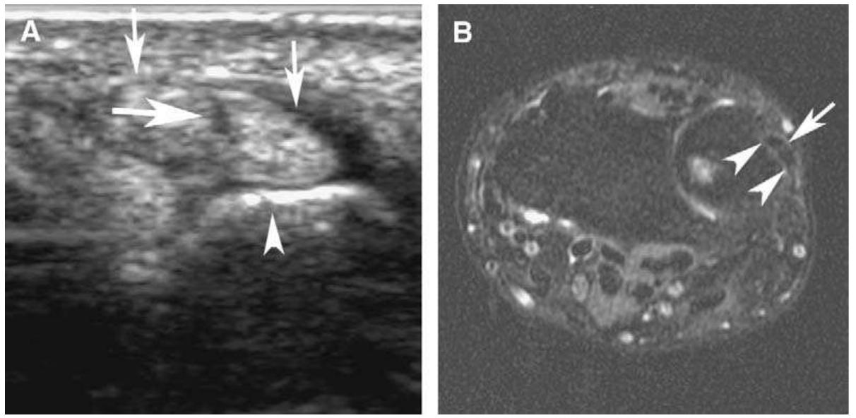 Tear of the extensor carpi ulnaris tendon. (a) transverse