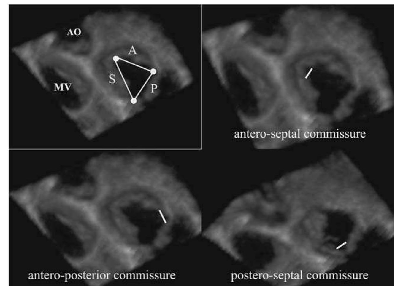 Figure 4 - Assessment of normal tricuspid valve anatomy in