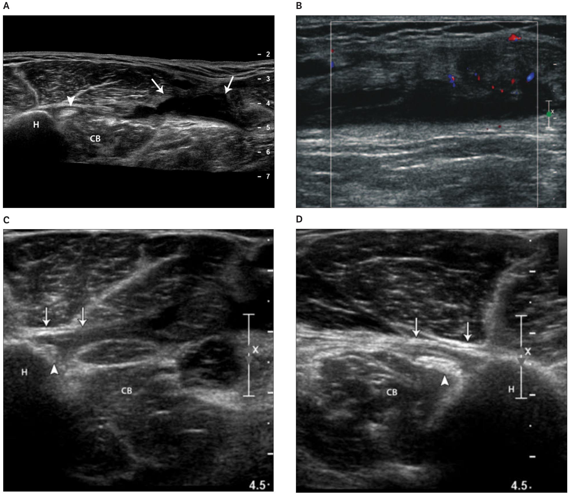 Images from a 44-year-old man with complete distal avulsion