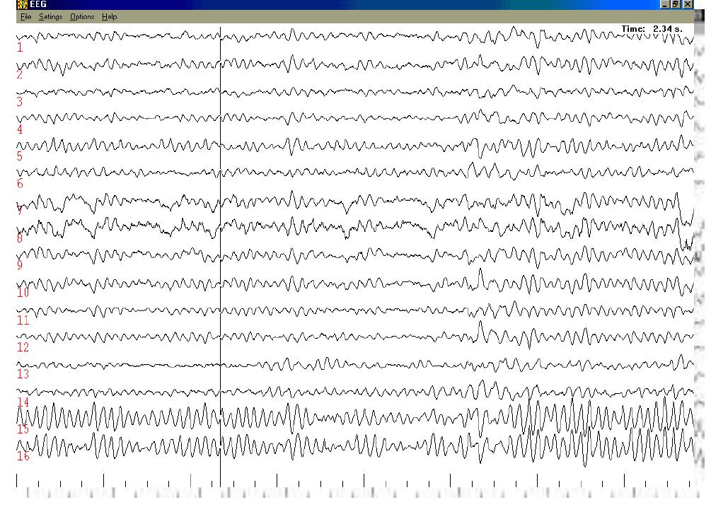 ‘igure #. standard waveform view in the eeg examination