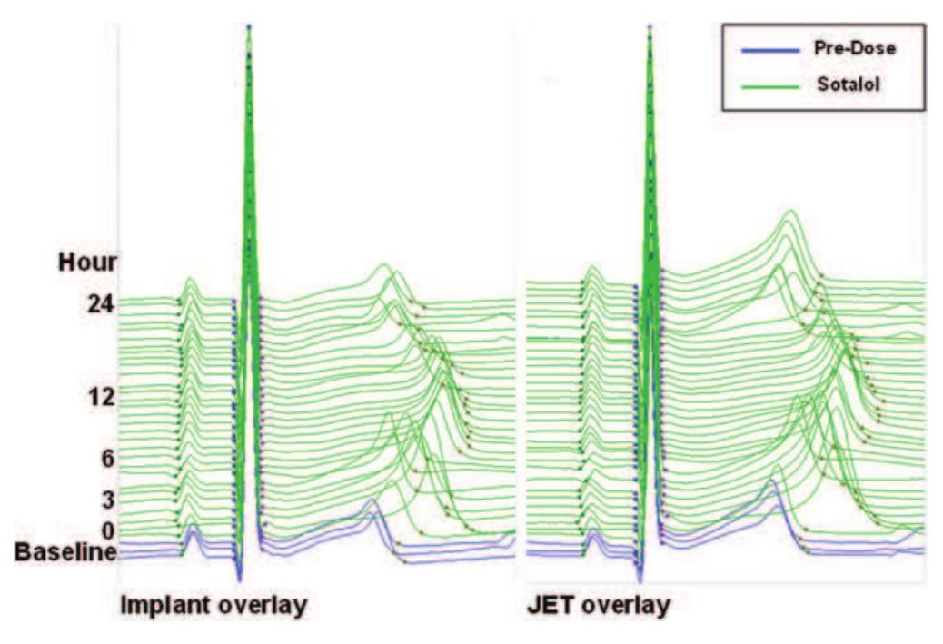 Figure 2 Detection Of Qtc Interval Prolongation Using
