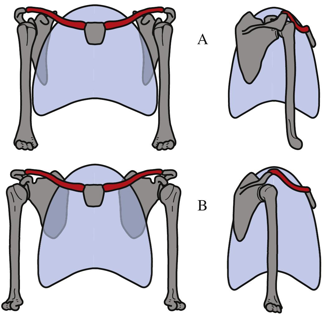 Competing reconstructions of the knm-wt 15000 shoulder.