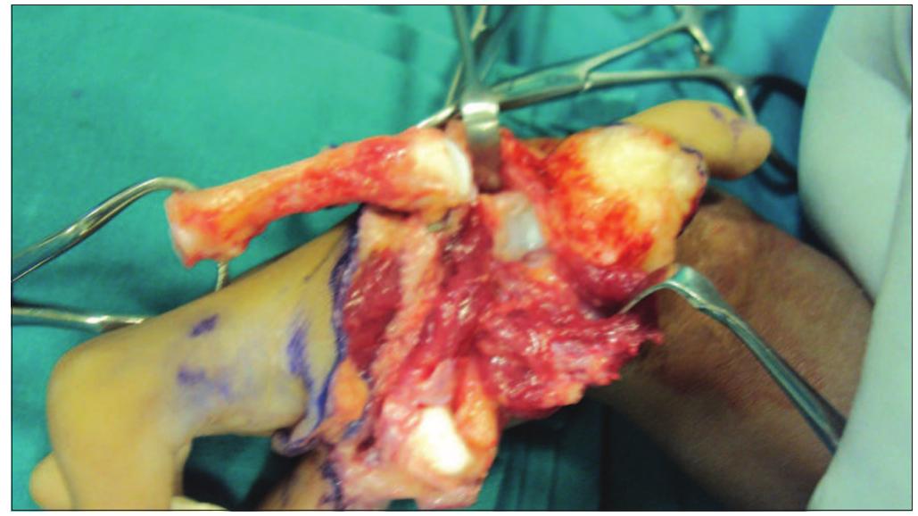Metacarpal excised carpo metacarpal joint seen