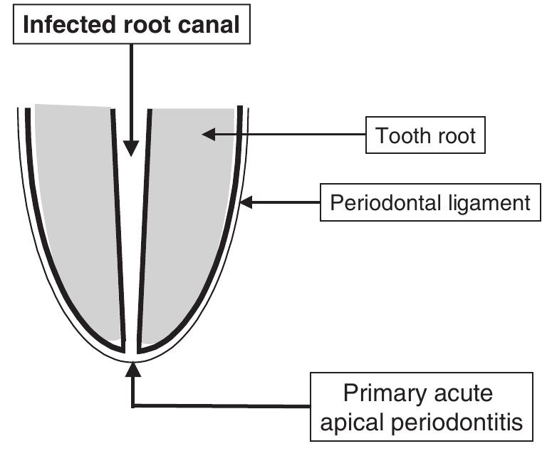 (PDF) Classification, diagnosis and clinical manifestations of apical ...