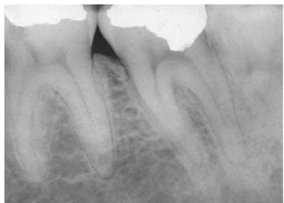 Periapical radiograph of a lower left second molar tooth