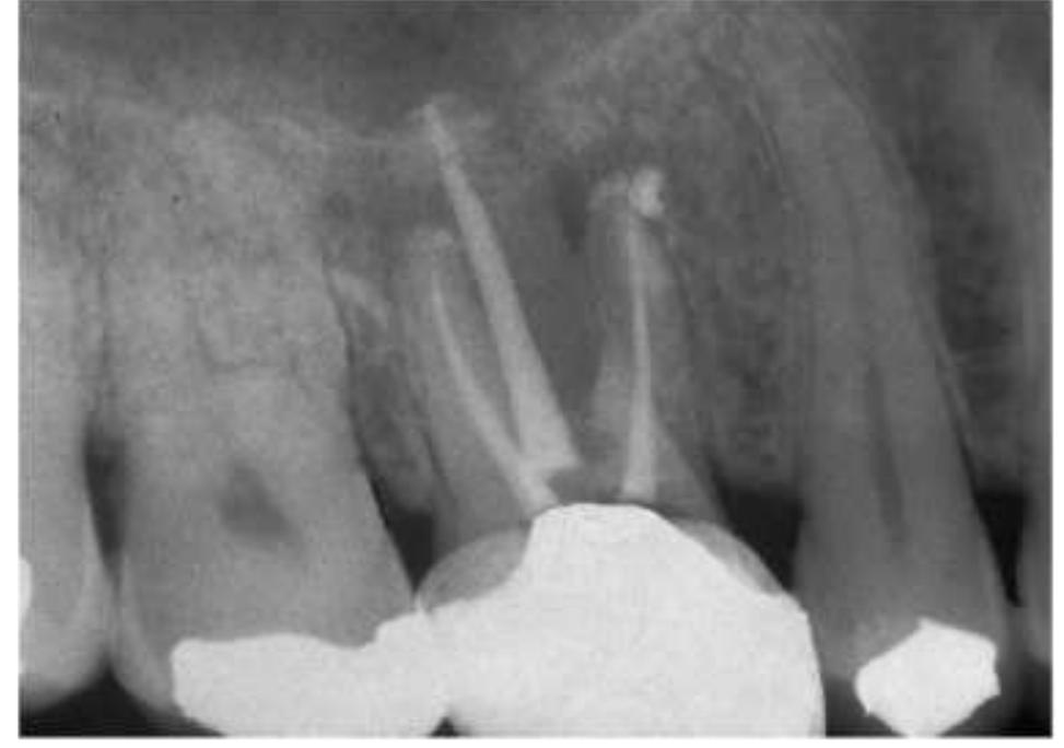 (PDF) Classification, diagnosis and clinical manifestations of apical ...
