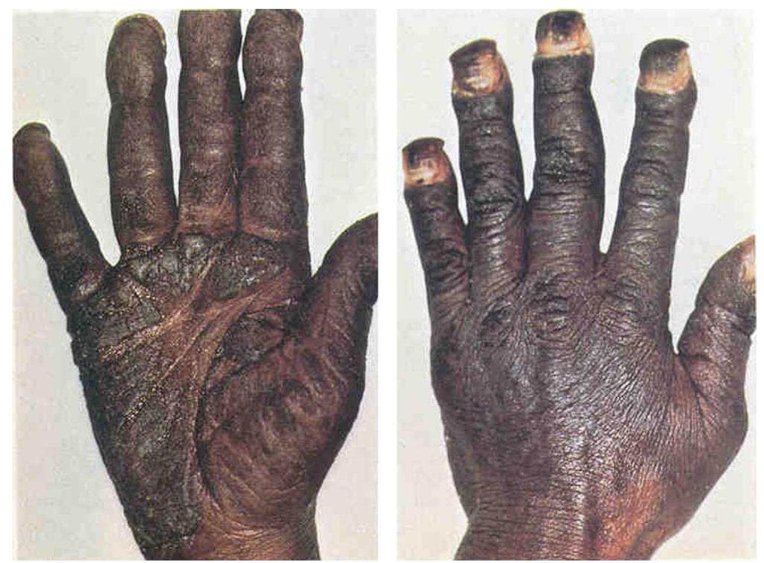 Bazex’s syndrome. in the case shown, there was an associated