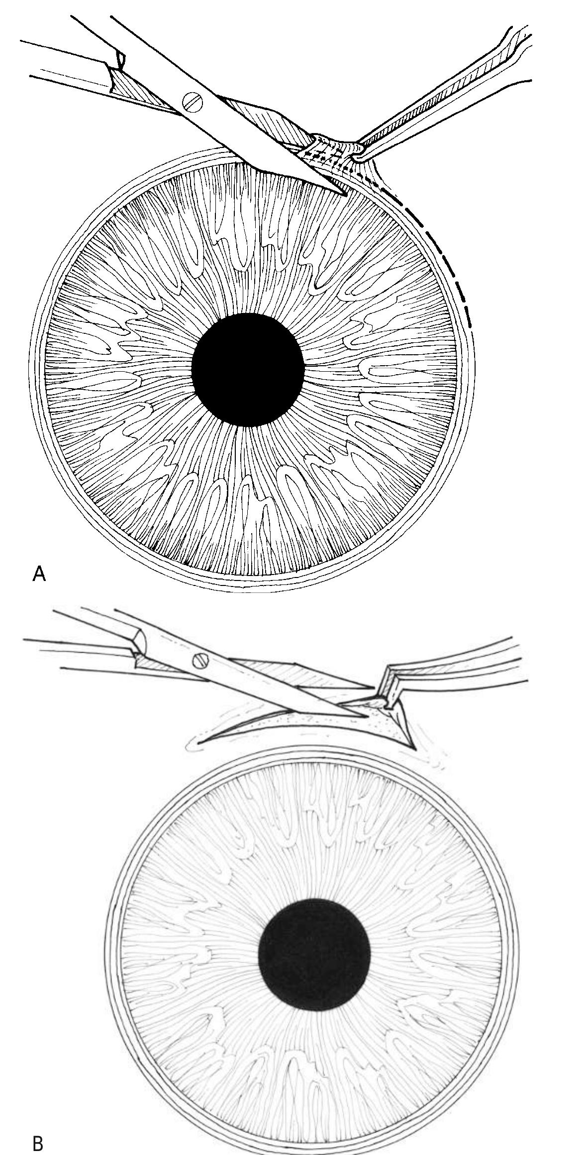 -2 a, limbal conjunctival incision is made to create a