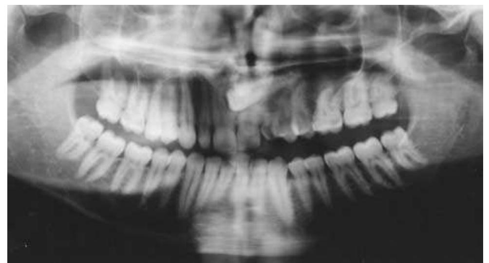 Patient 5 (maxillary). cropped panoramic radiograph reveal-