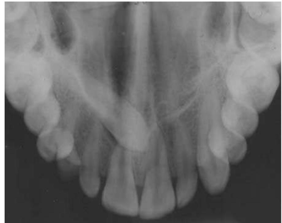 Patient 4 (maxillary). occlusal radiograph showing transmi-