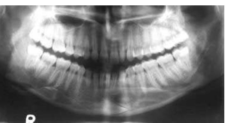 Patient 5 (mandibular). cropped panoramic radiograph showing