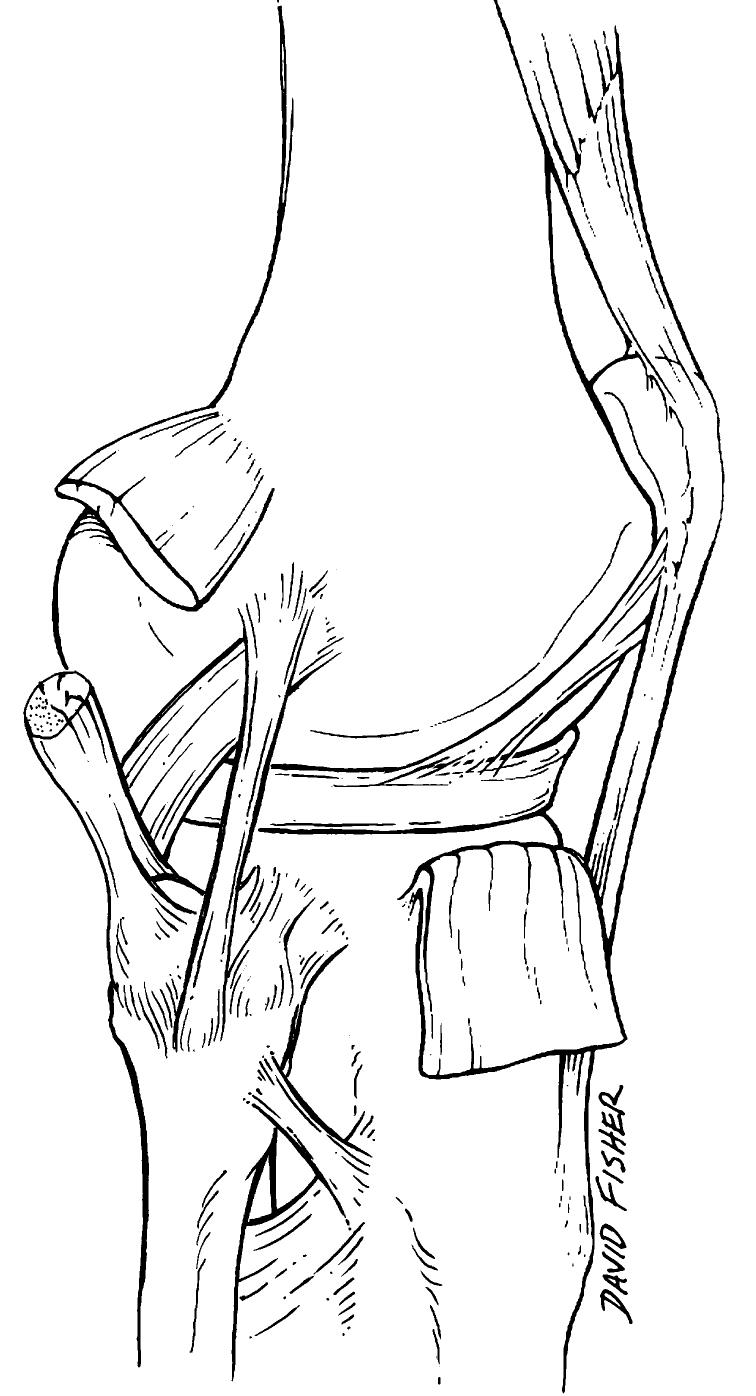 Schematic drawing of the right distal thigh and proximal leg