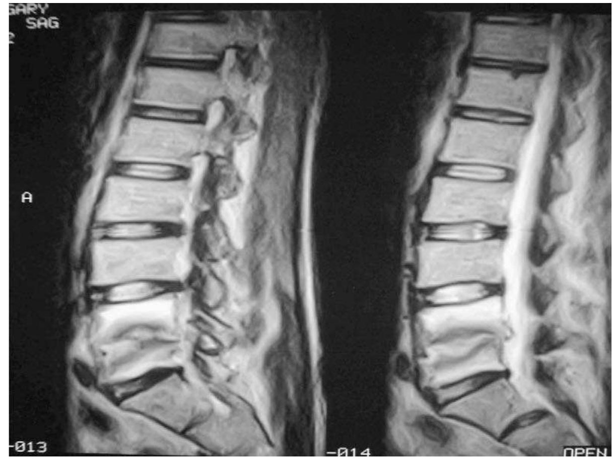 T2-weighted mri scan of the lumbar spine demonstrates