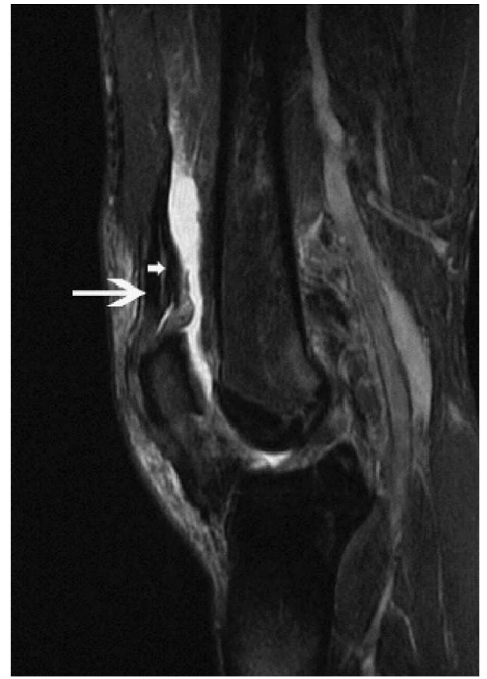 Sagittal t2 weighted fat saturated mri knee demon- strates