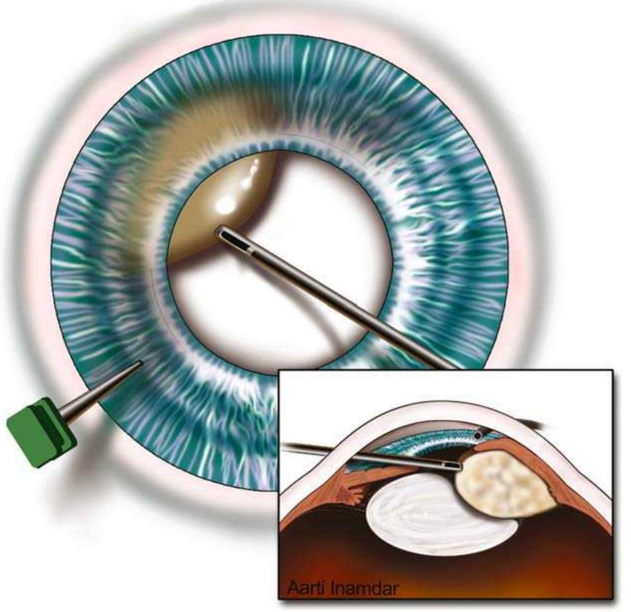 2 anterior segment biopsy: optional is the placement of the