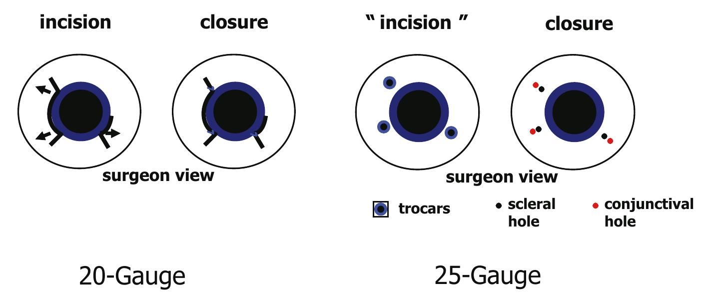 1 the diagram illustrates the reduced conjunctival cutting