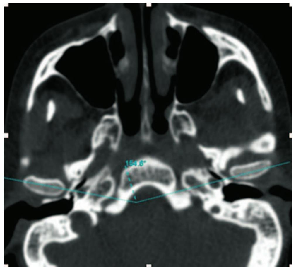 Perpendicular axial ct imaging in both condyles. the blue