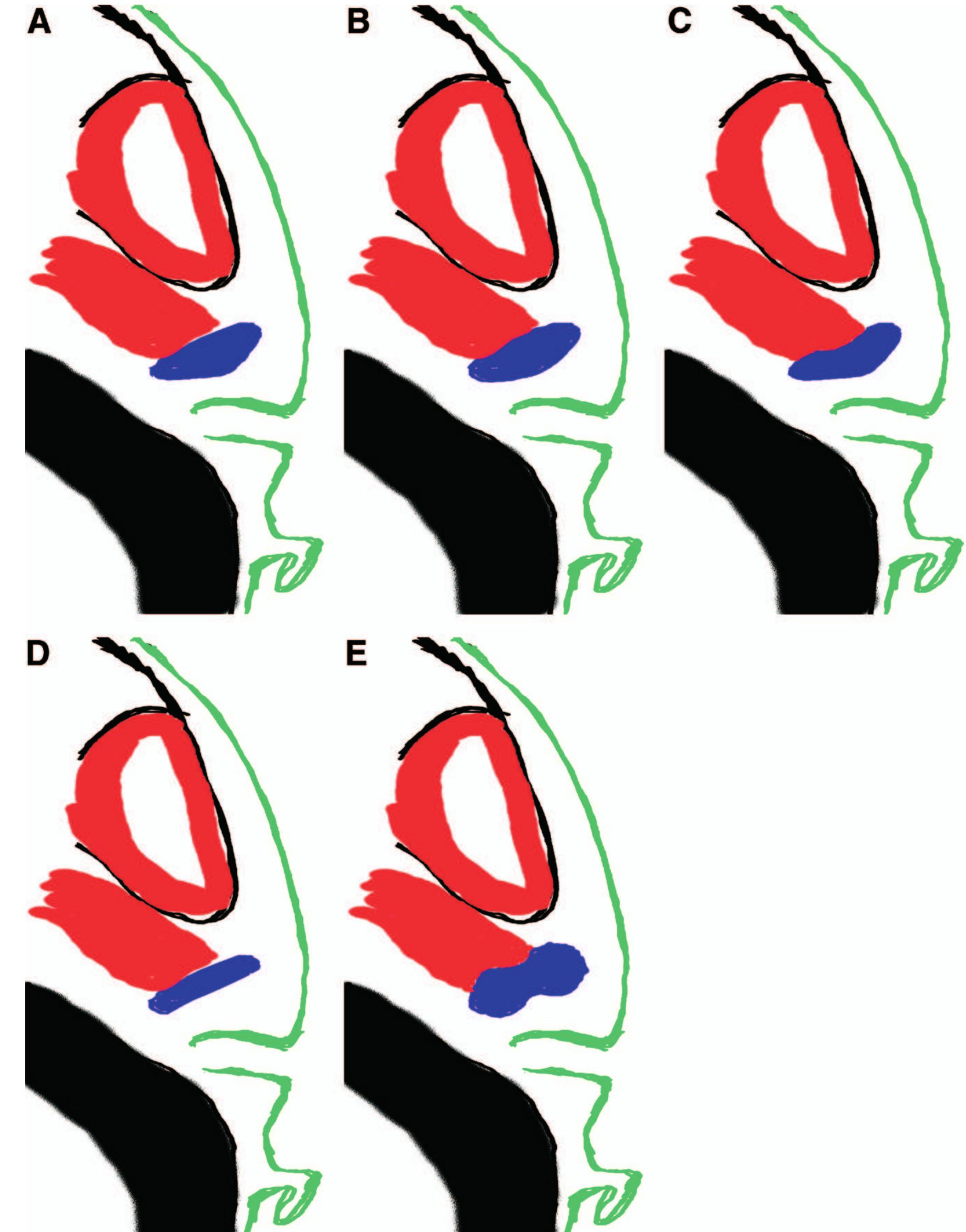 Figure 3 - Anatomy of the Temporomandibular Joint