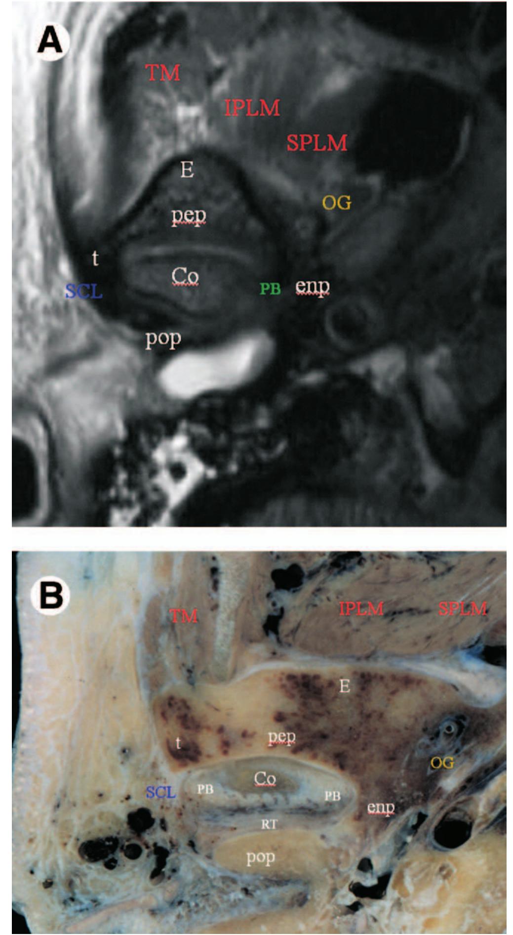 Axial plane of normal anatomy of tmj, t1 weighted images and