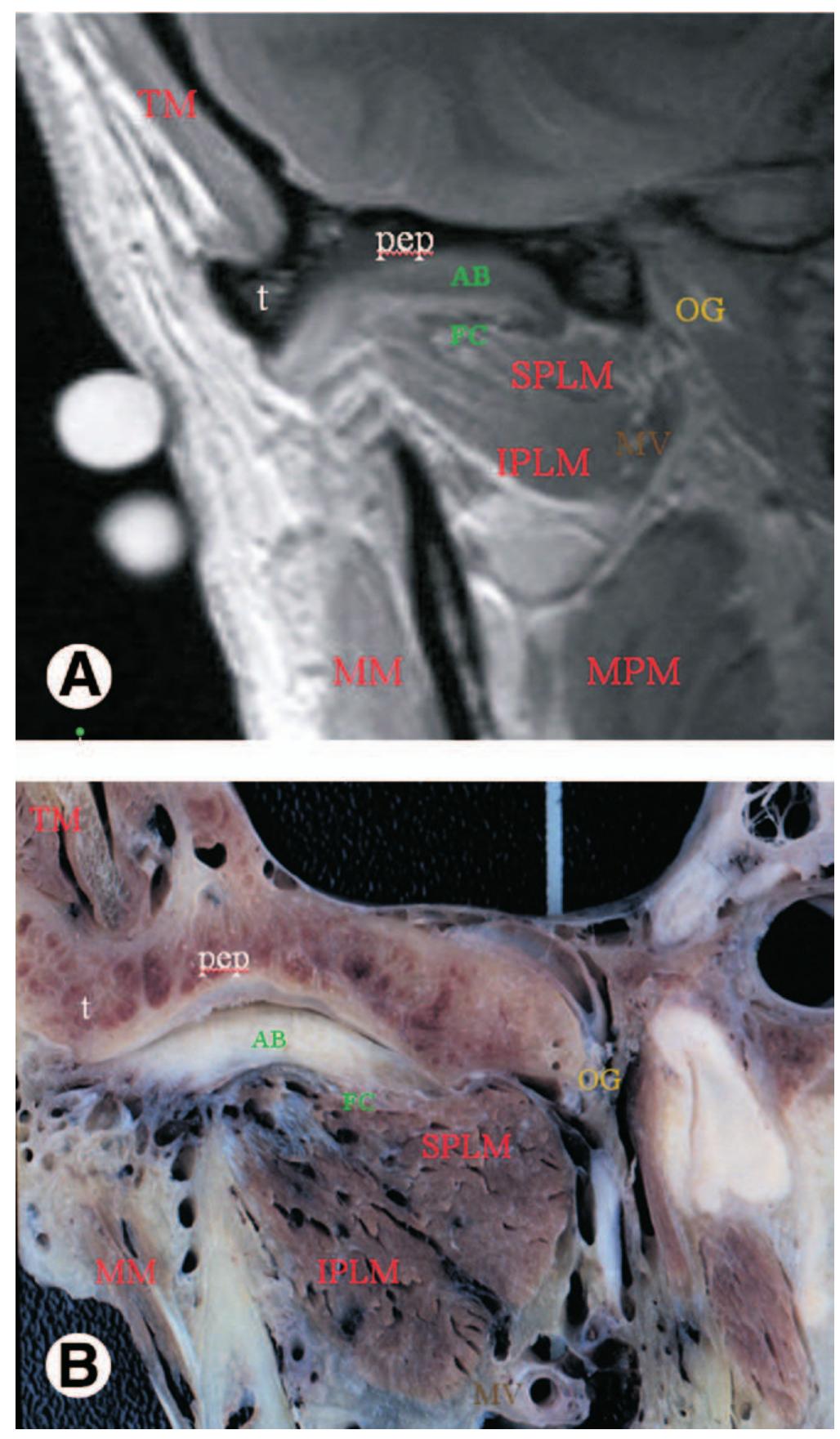 Paracoronal plane of normal anatomy of tmj, t1 weighted