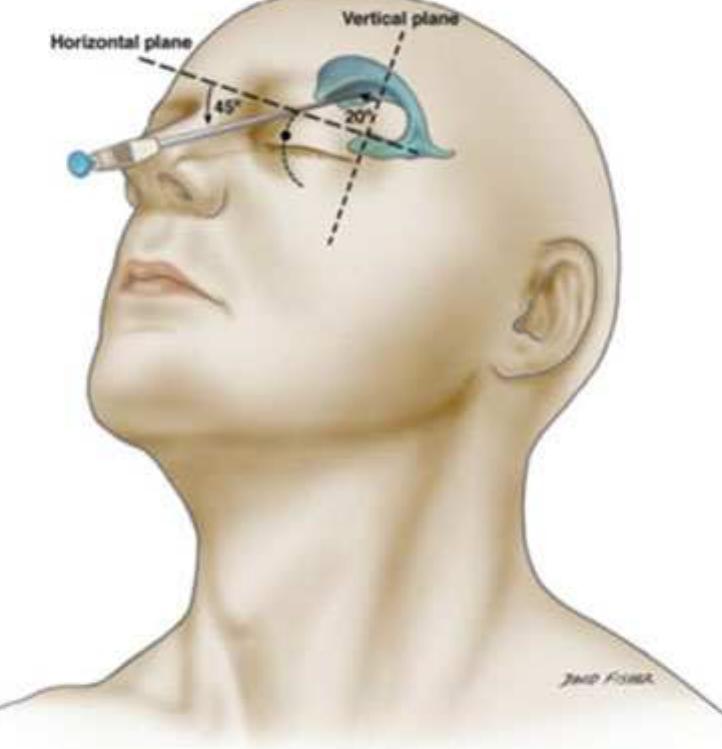 Schematic illustration of access to the frontal horn through