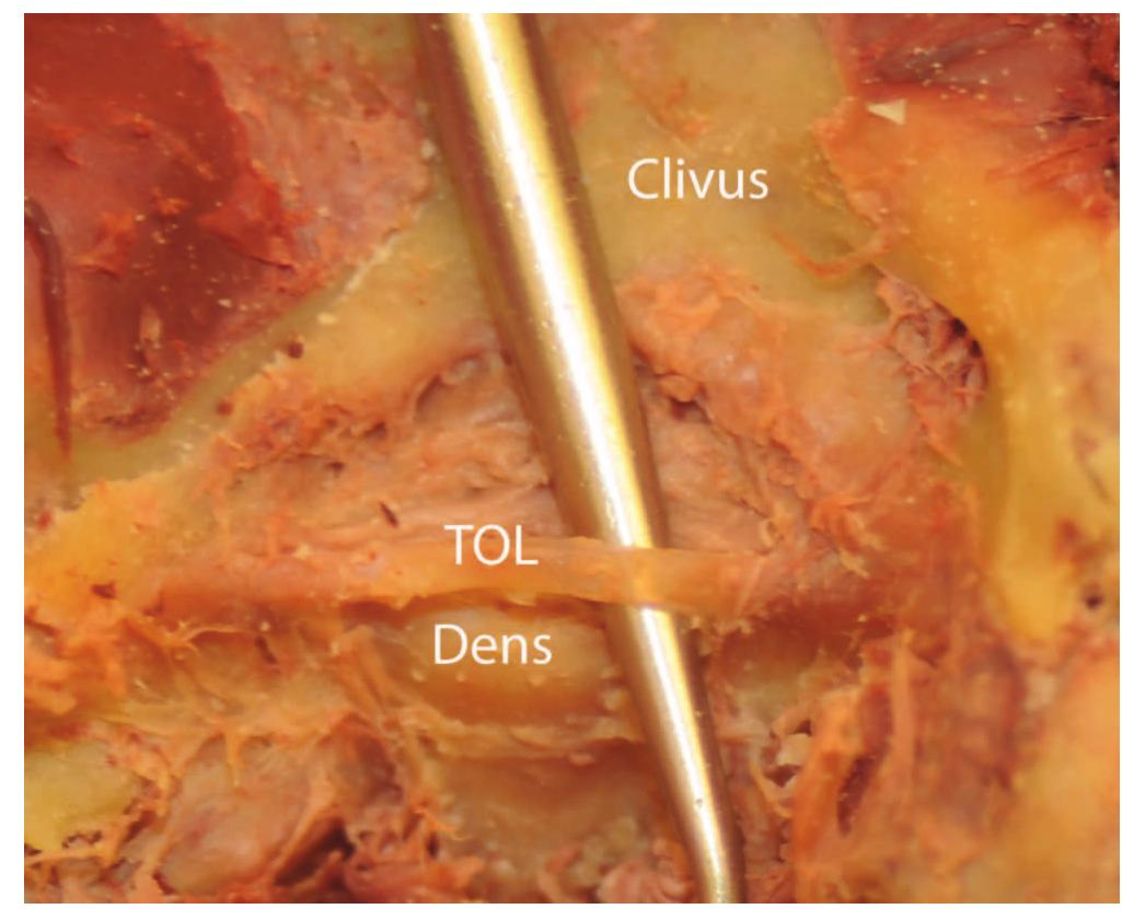 Fic. 3. cadaveric dissection noting the transverse occipital