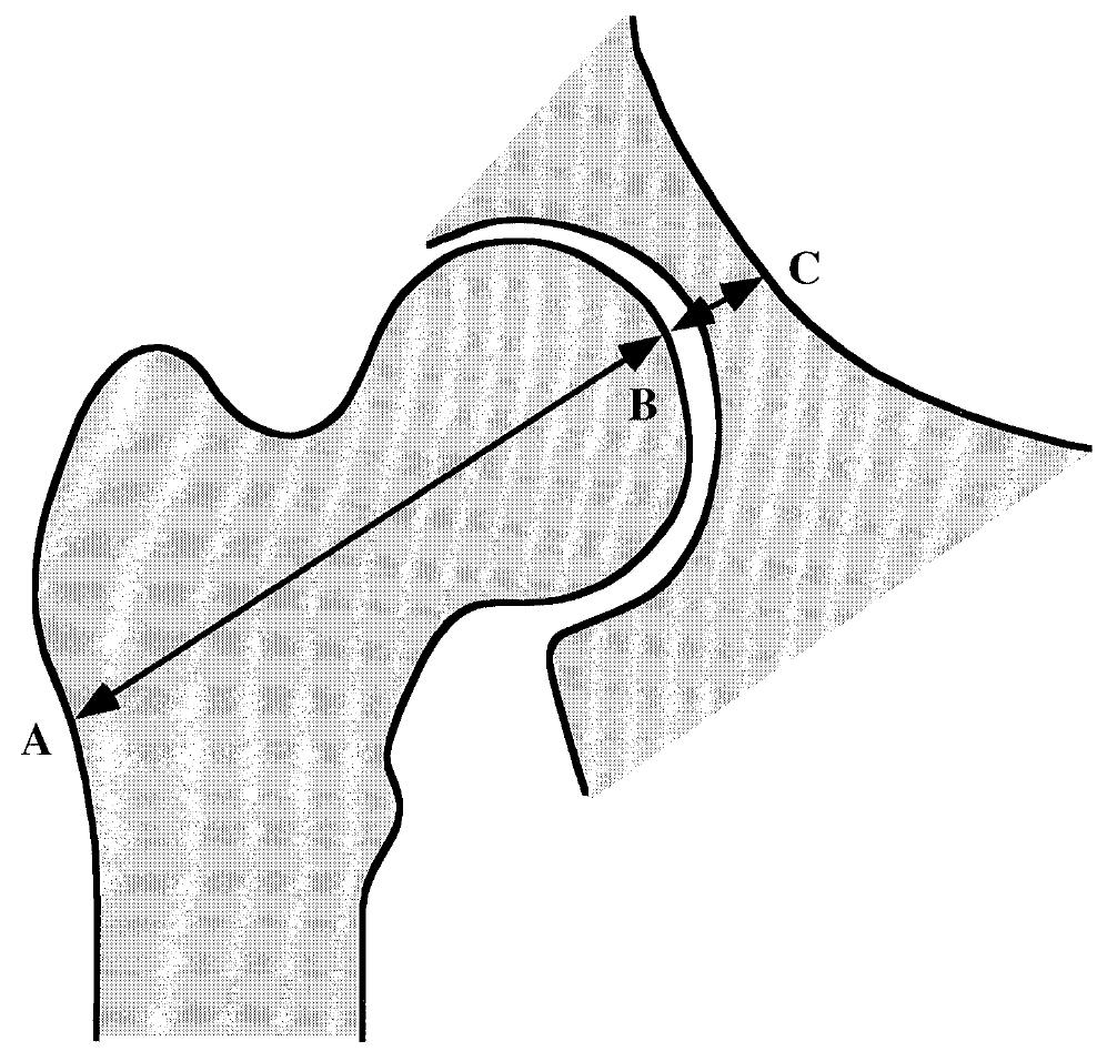 Figure 1 - from Femoral Neck Axis Length, Height Loss and