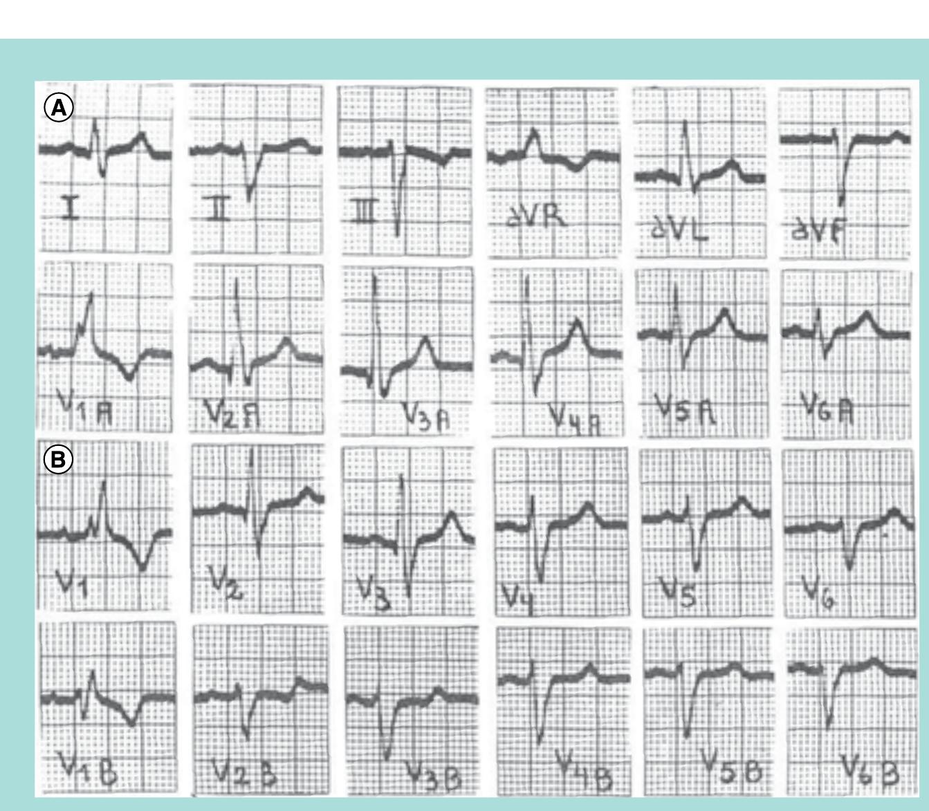 Right bundle branch block with left anterior fascicular