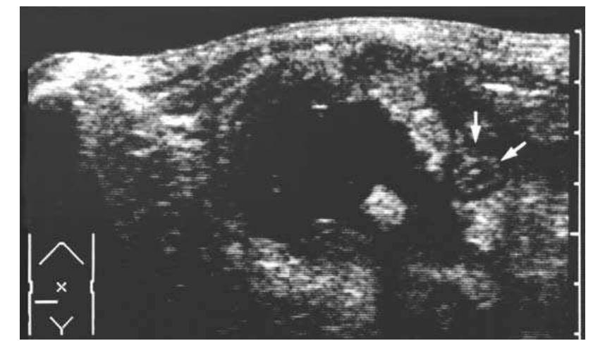 Appendiceal abscess. large abscess cavity contains a