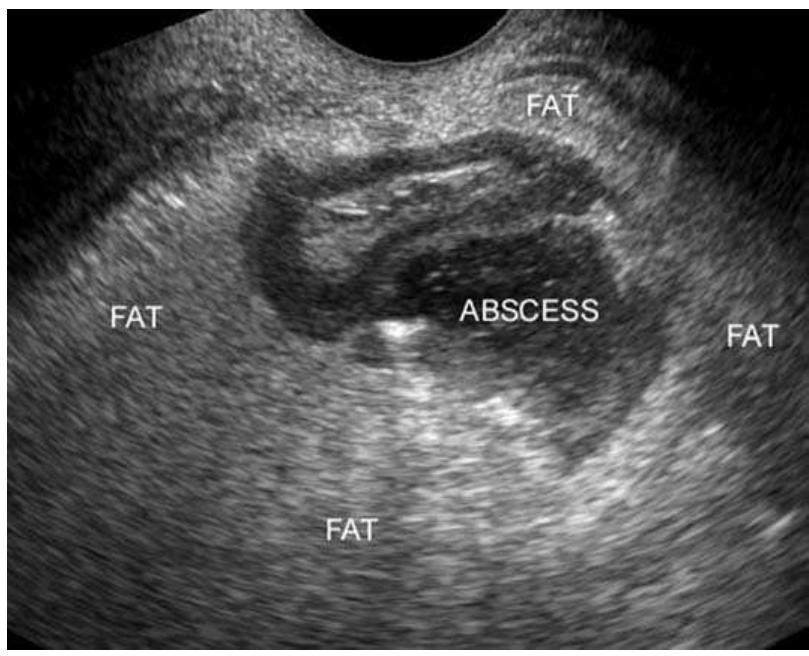 Paracolic abscess caused by diverticulitis, effectively