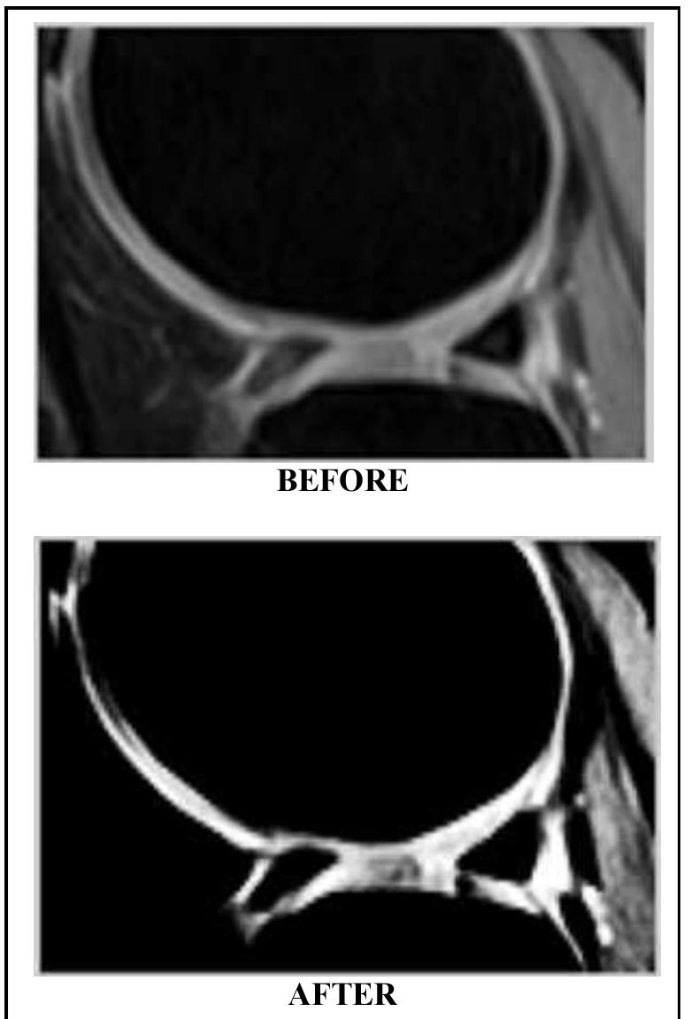 Contrast enhancement for mr images of knee we have applied