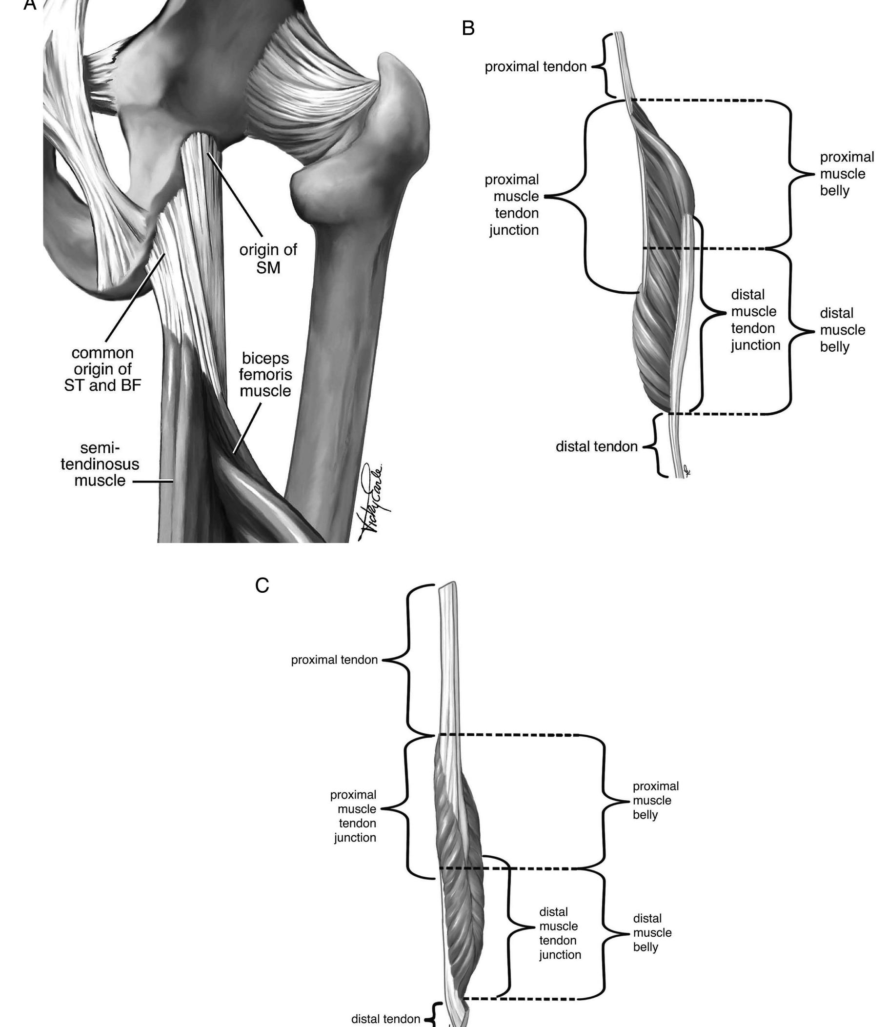 Part (a) proximal hamstring origin. (b) type