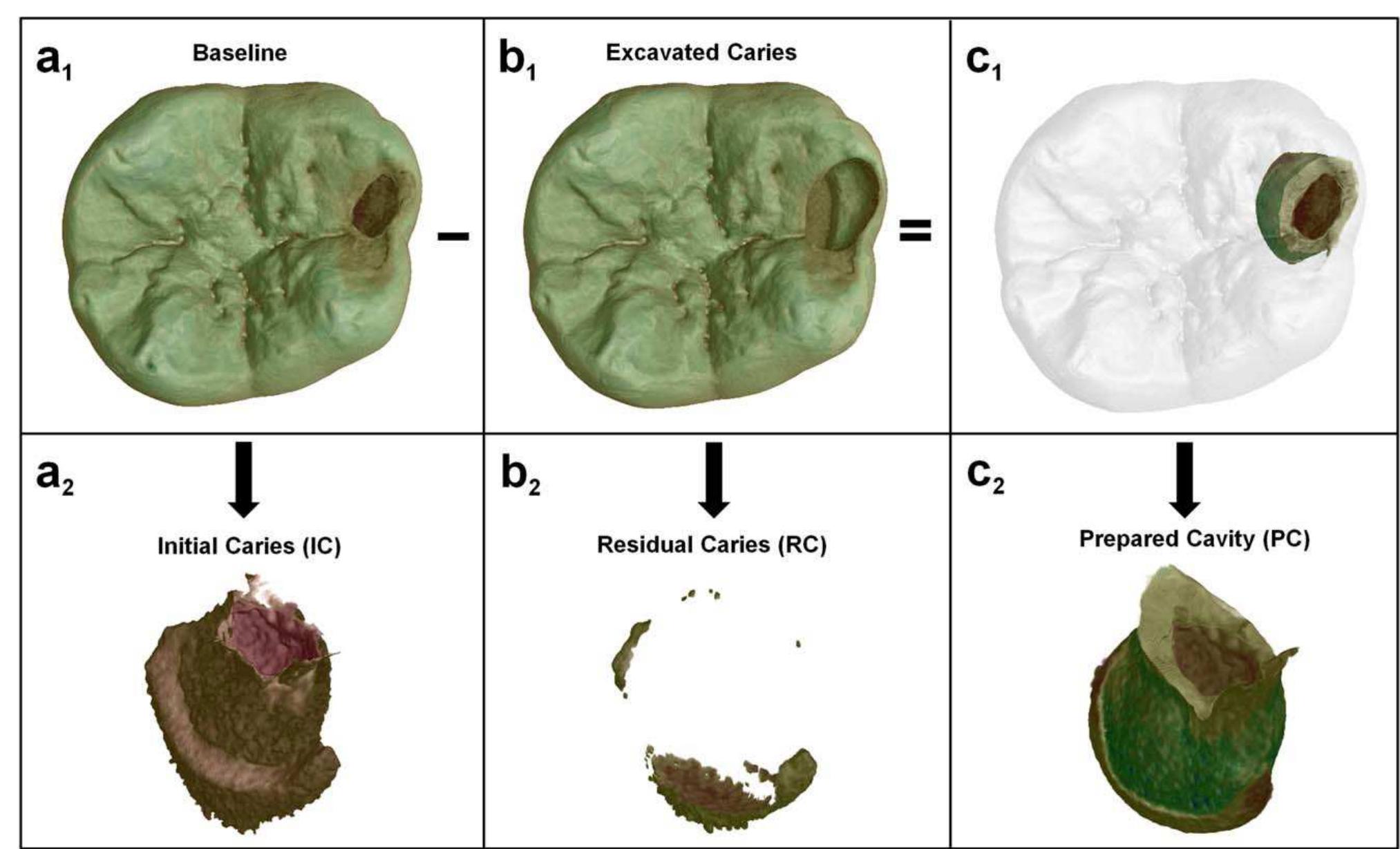 Figure 1 - from Caries-removal effectiveness and