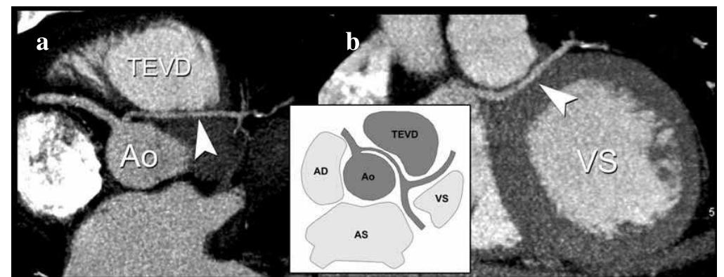 A,b anomalous left coronary artery (acs) arising from the