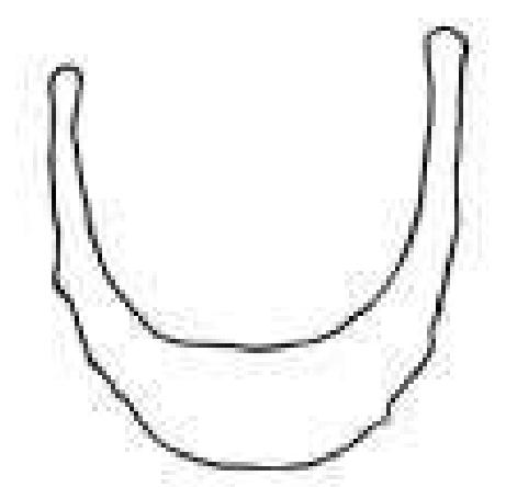 Asymmetrical hyoid bone. criterion for classifying hyoid