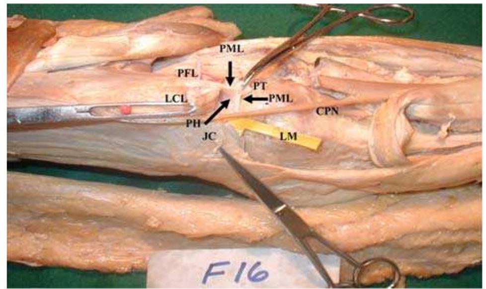 Popliteus hiatus (ph) (exposed), popliteus tendon (pt)