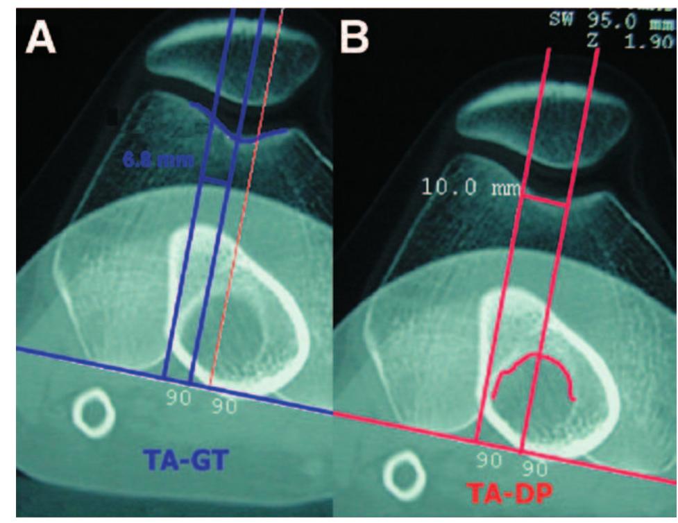 Ct scans: femur and tibia rotation. (a) the ta-gt index