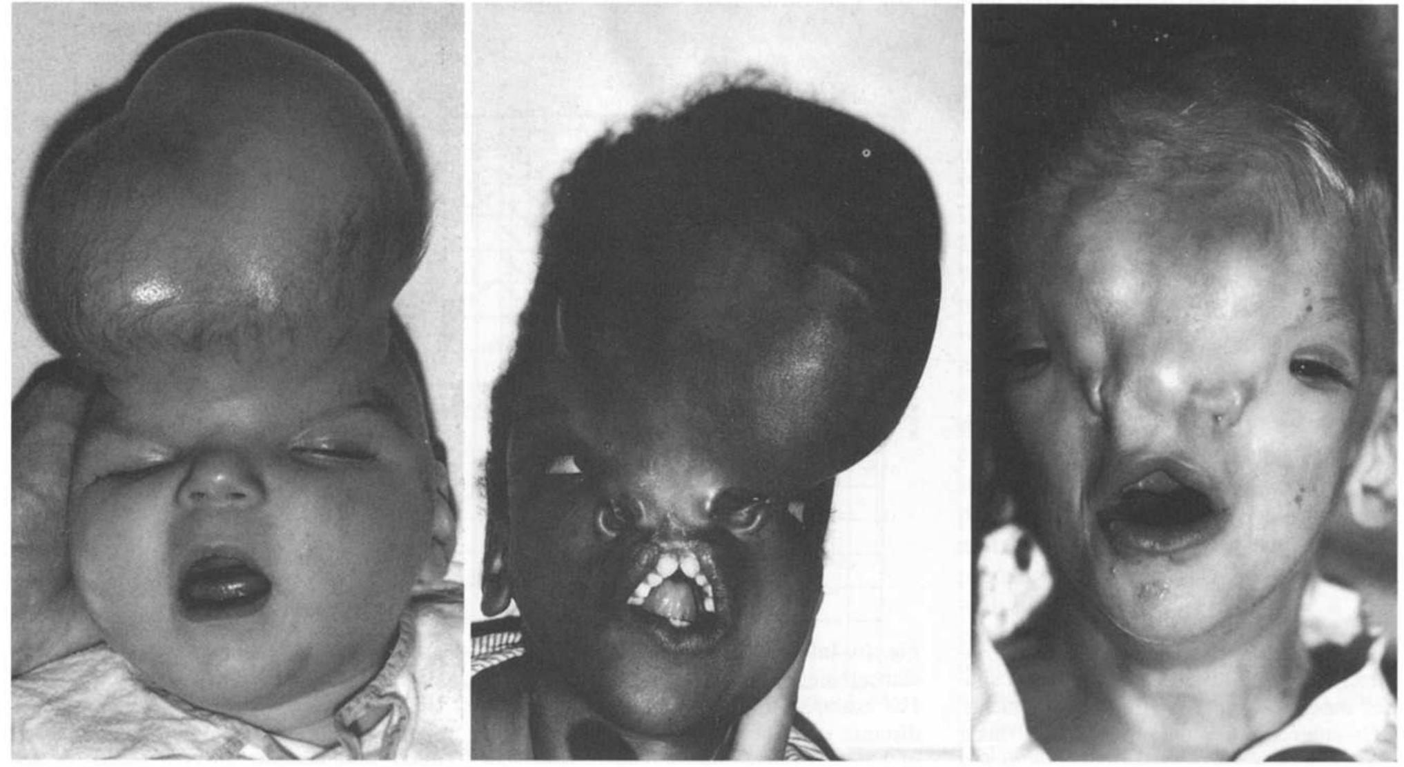 From left to right: frontal encephalocele, frontonasal