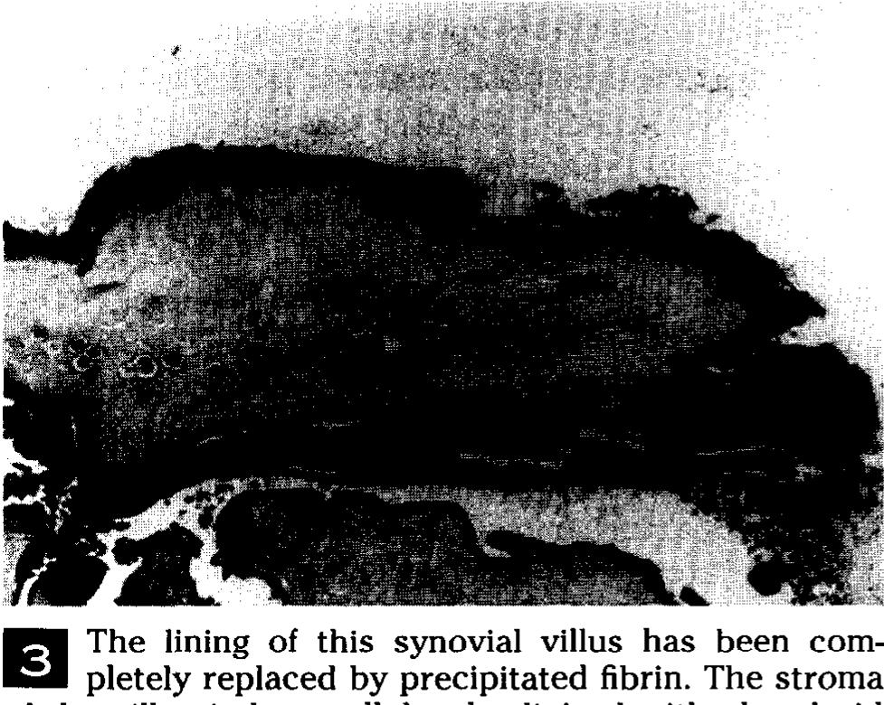 Figure 3 - Synovial cysts of the lumbar spine: Diagnosis,