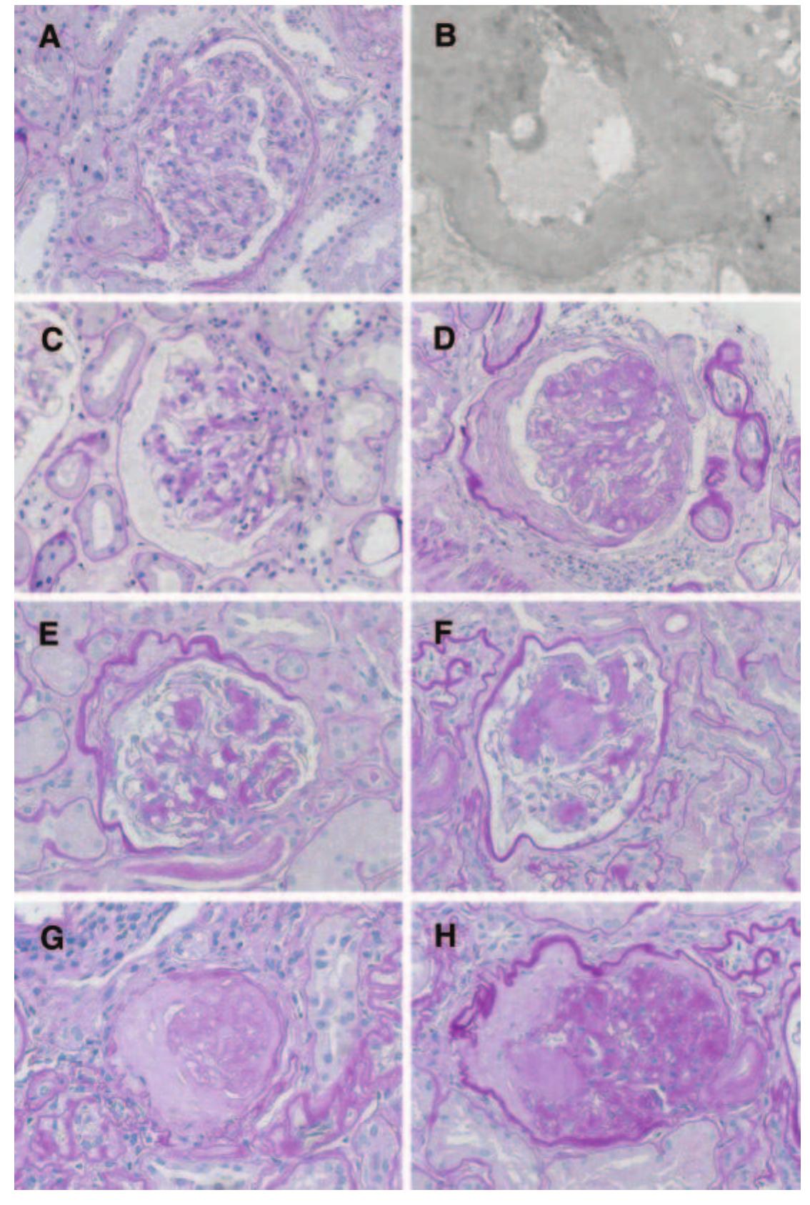 Representative examples of the morphologic lesions in dn.