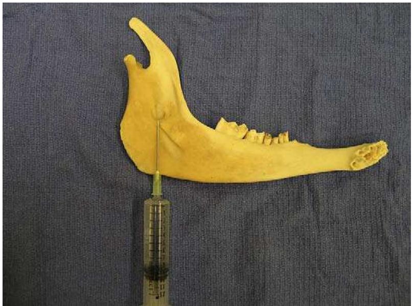 Medial aspect of the mandible. injection of local anesthetic