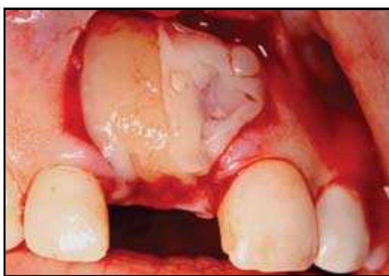 (PDF) Introducing Choukroun’s Platelet Rich Fibrin (PRF) to the ...