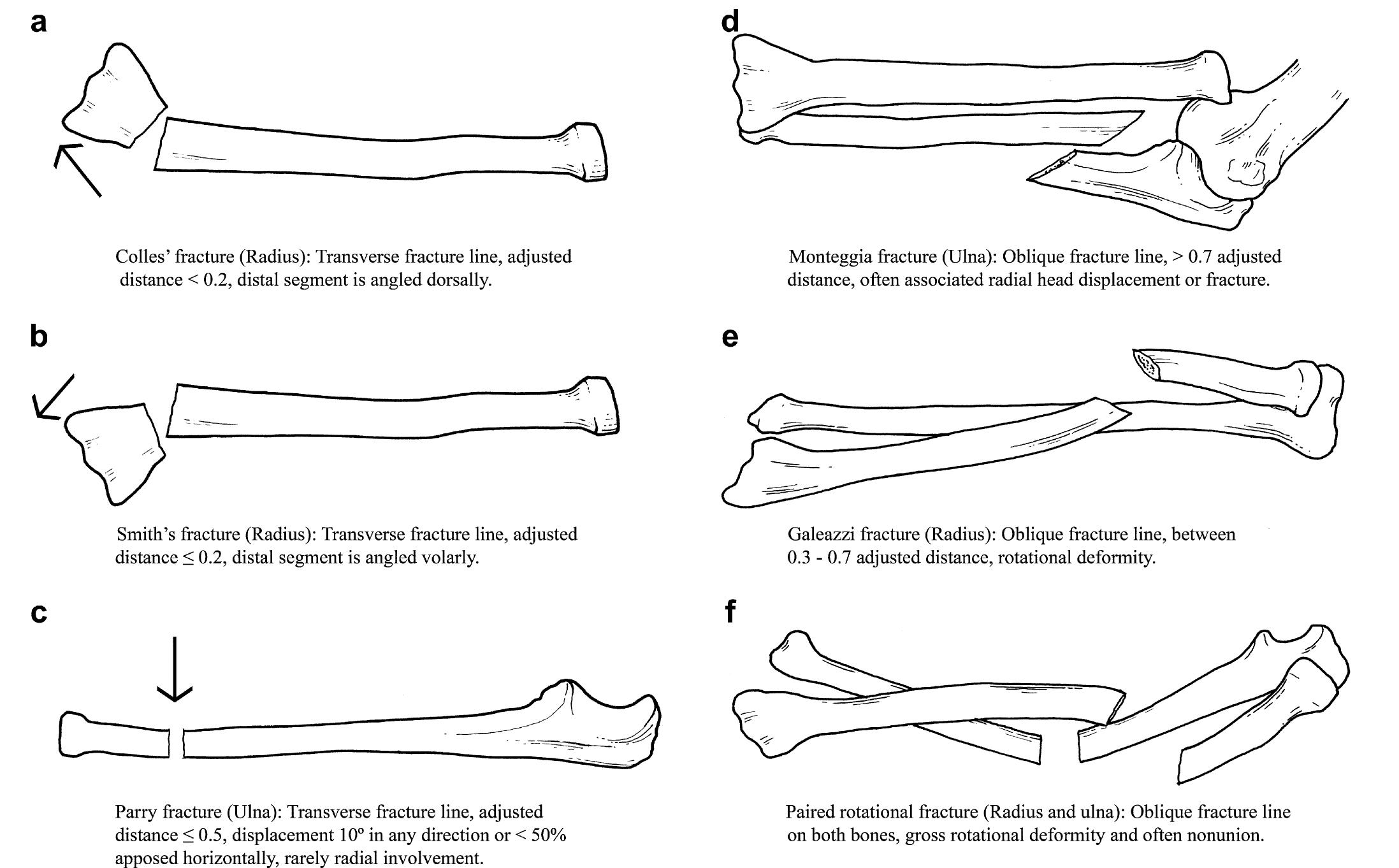 Summary of diagnostic criteria for acute forearm fractures.
